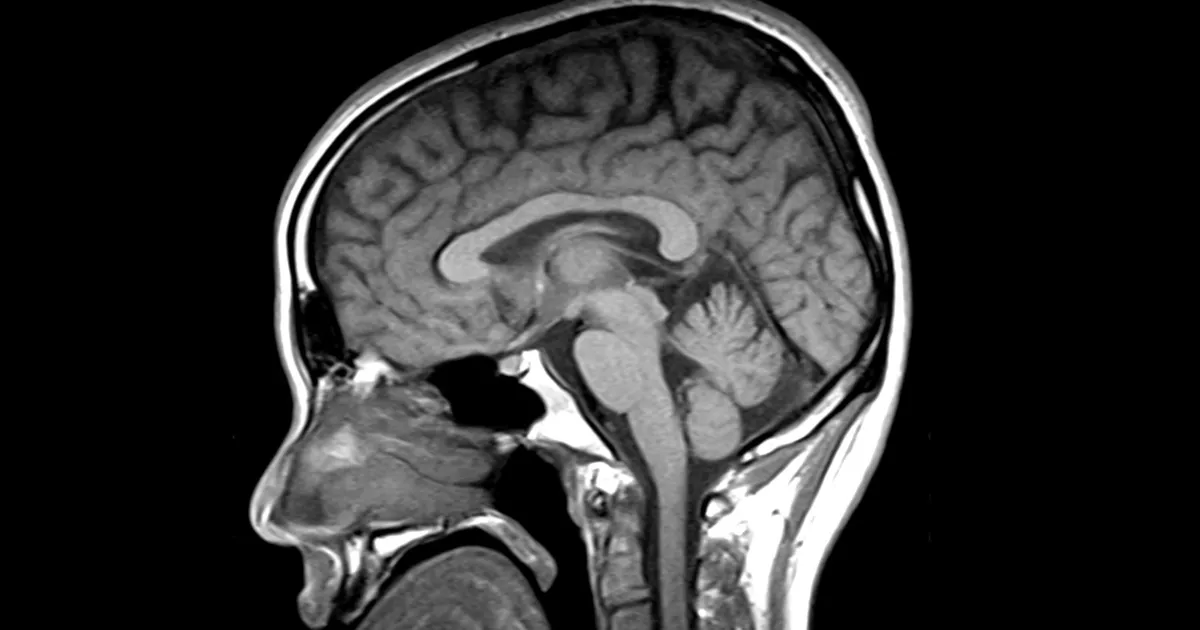 Kolmel inimesel sajast tekib raske ajuhaigus ja keegi ei oska seda ette ...